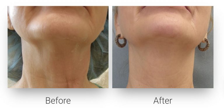 Facial Contouring and Lifting – Vida Lift Clinic Center